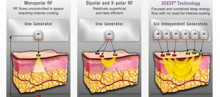 Radiofrecuencia EndyMed 3DEEP - Estética Ana Pastor